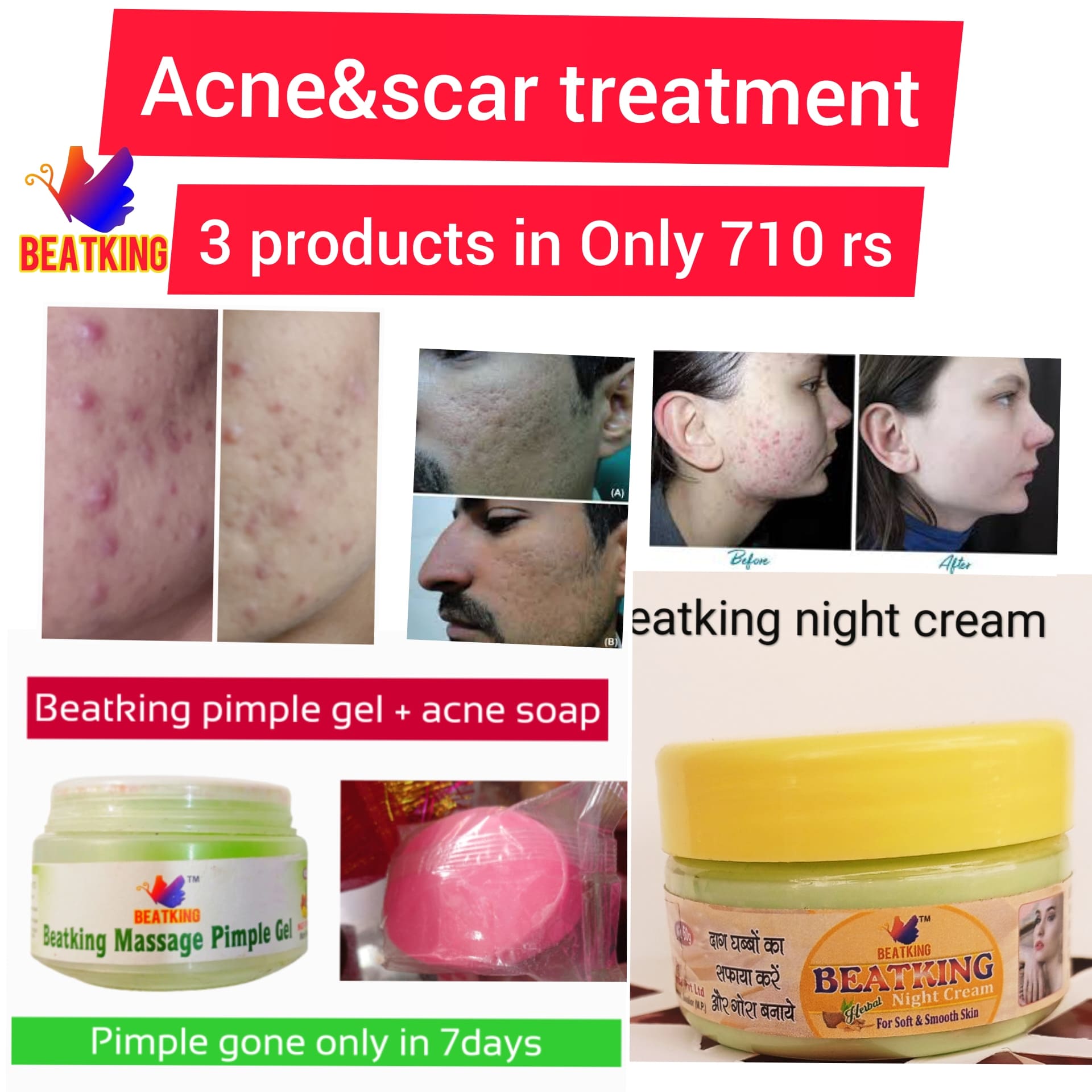 Beatking Acne And Scar Treatment Kit – beatking herbal
